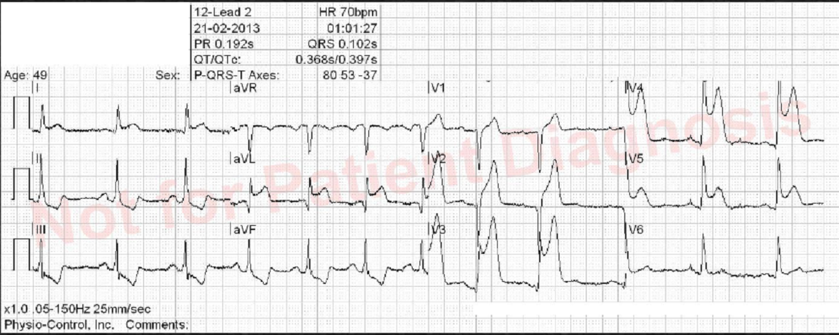 Results - Weekly Cardio ECG and Case Quiz!! Question #14