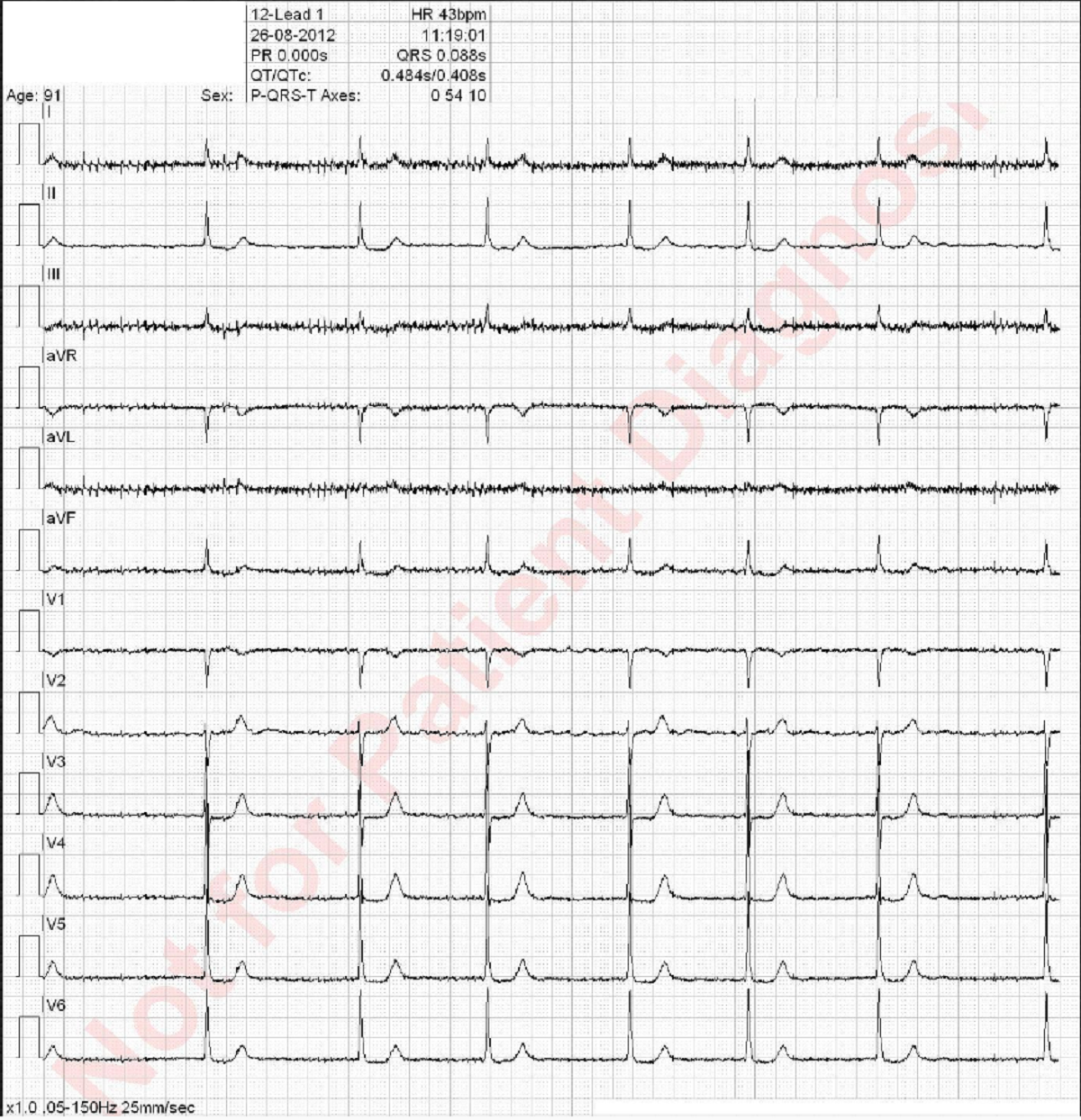 Results - Weekly Cardio ECG and Case Quiz!! Question #9